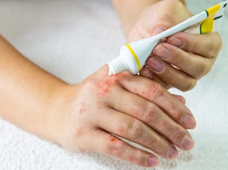 Dyshidrose : Découvrez les meilleurs remèdes pour vaincre l'eczéma ...