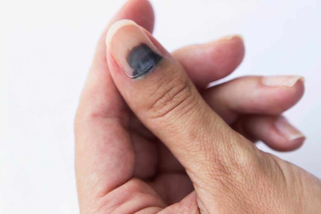 Ongle noir ? Découvrez les solutions efficaces pour agir rapidement