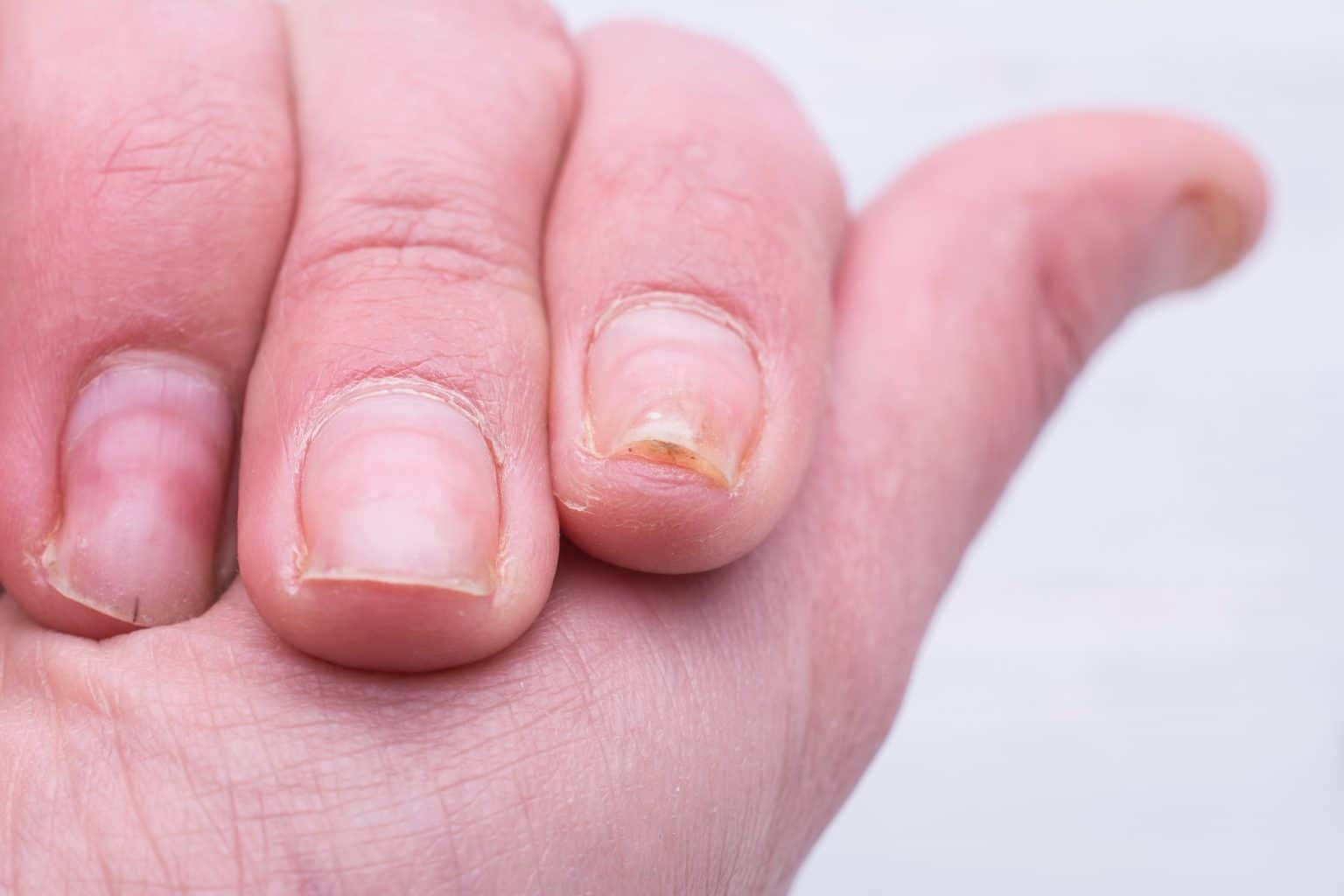 Ongle décollé : astuces pour soigner mycose et choc